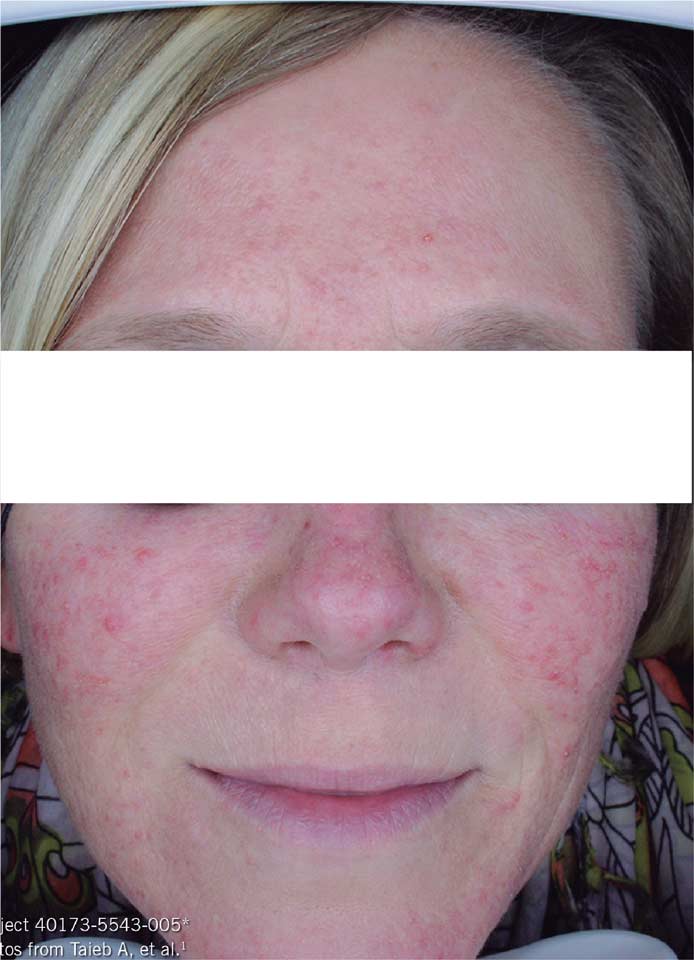 Mitos y verdades sobre la rosácea - Portal Red Salud